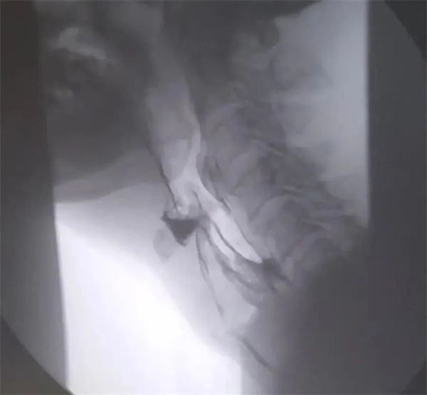 “咽”之难求 一“管”处之 | 吞咽造影+球囊扩张，治疗吞咽障碍 - 宝鸡市人民医院